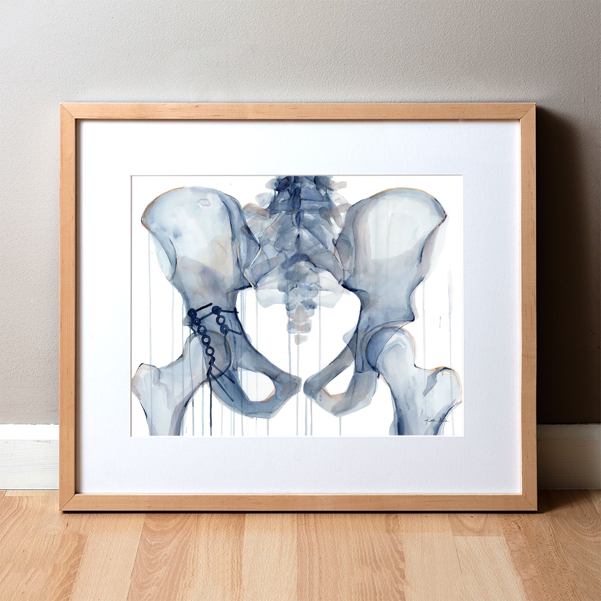 Drippy Pelvis Watercolor Print - Hip Repair Surgery - Gift for Surgeon ...